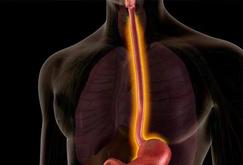 Οισοφαγίτιδα αίτια, συμπτώματα διάγνωση και θεραπεία