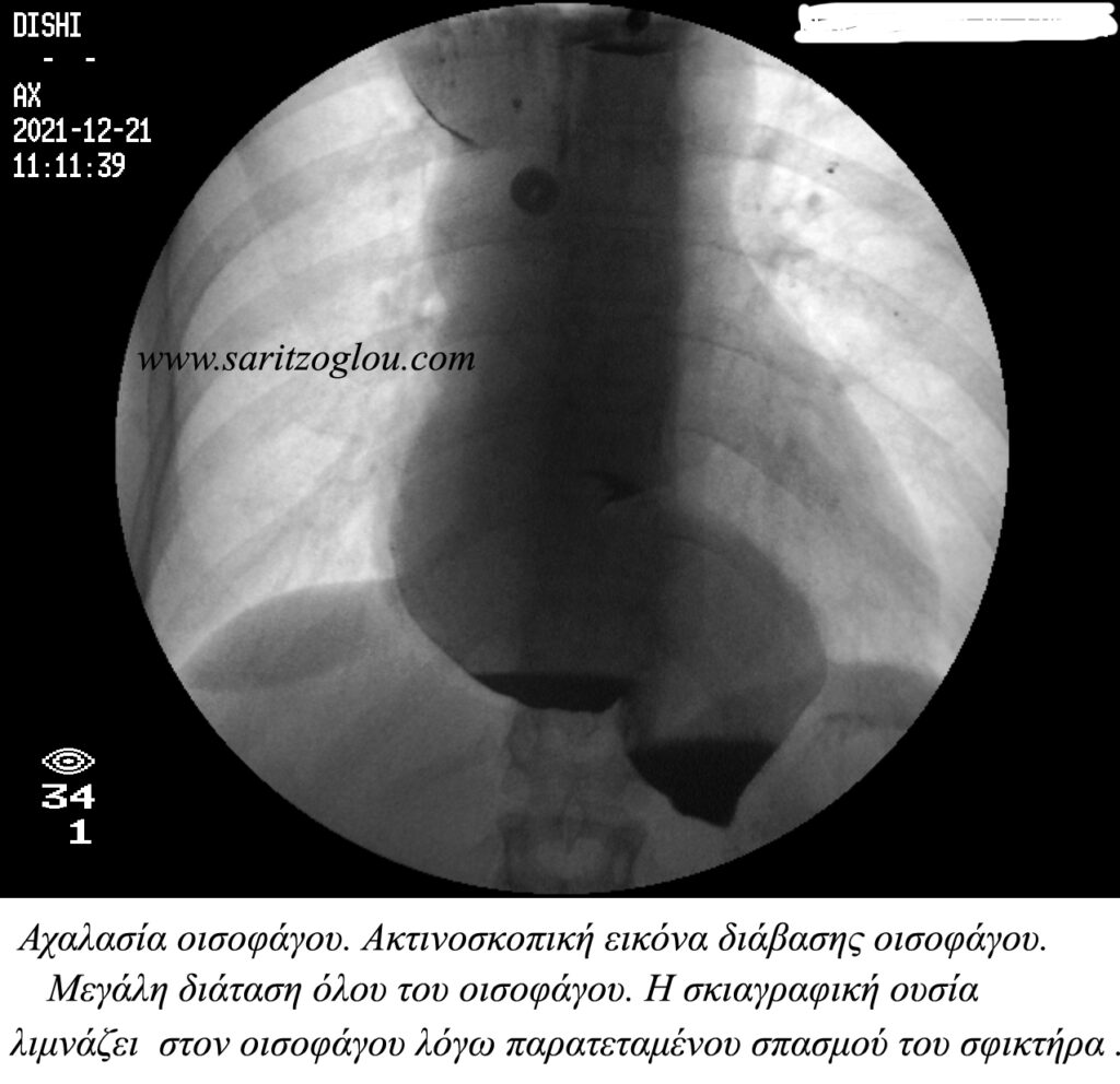Αχαλασία οισοφάγου φαρμακευτική ενδοσκοπική χειρουργική αντιμετώπιση